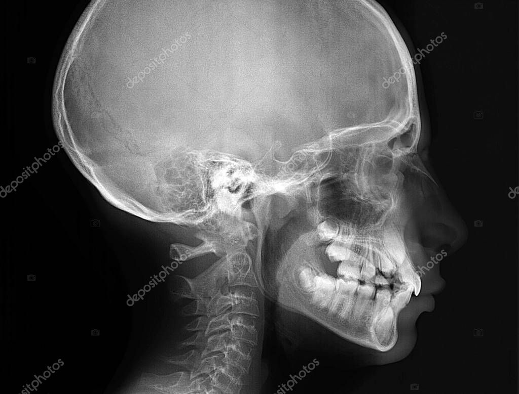 Película de rayos X cráneo y columna cervical vista lateral de niño de ...