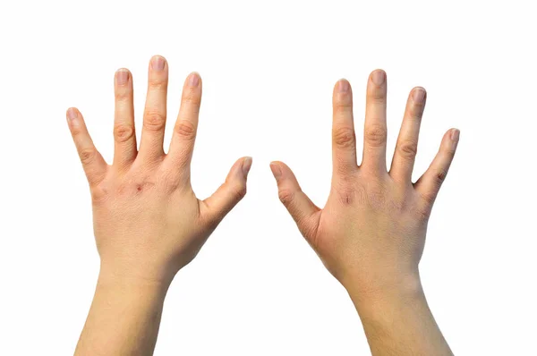 Withered Arm Syndrome