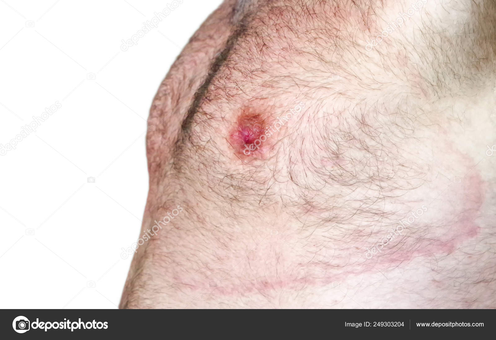 Borreliosis de Lyme - eritema migrans: fotografía de stock © jarino #249303204 | Depositphotos