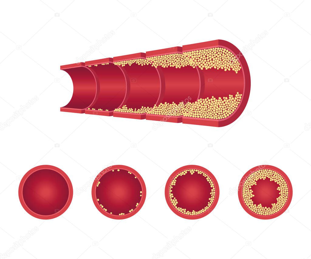 Vector arteria de la arteria de la arteria de la arteria aterosclerosis ...
