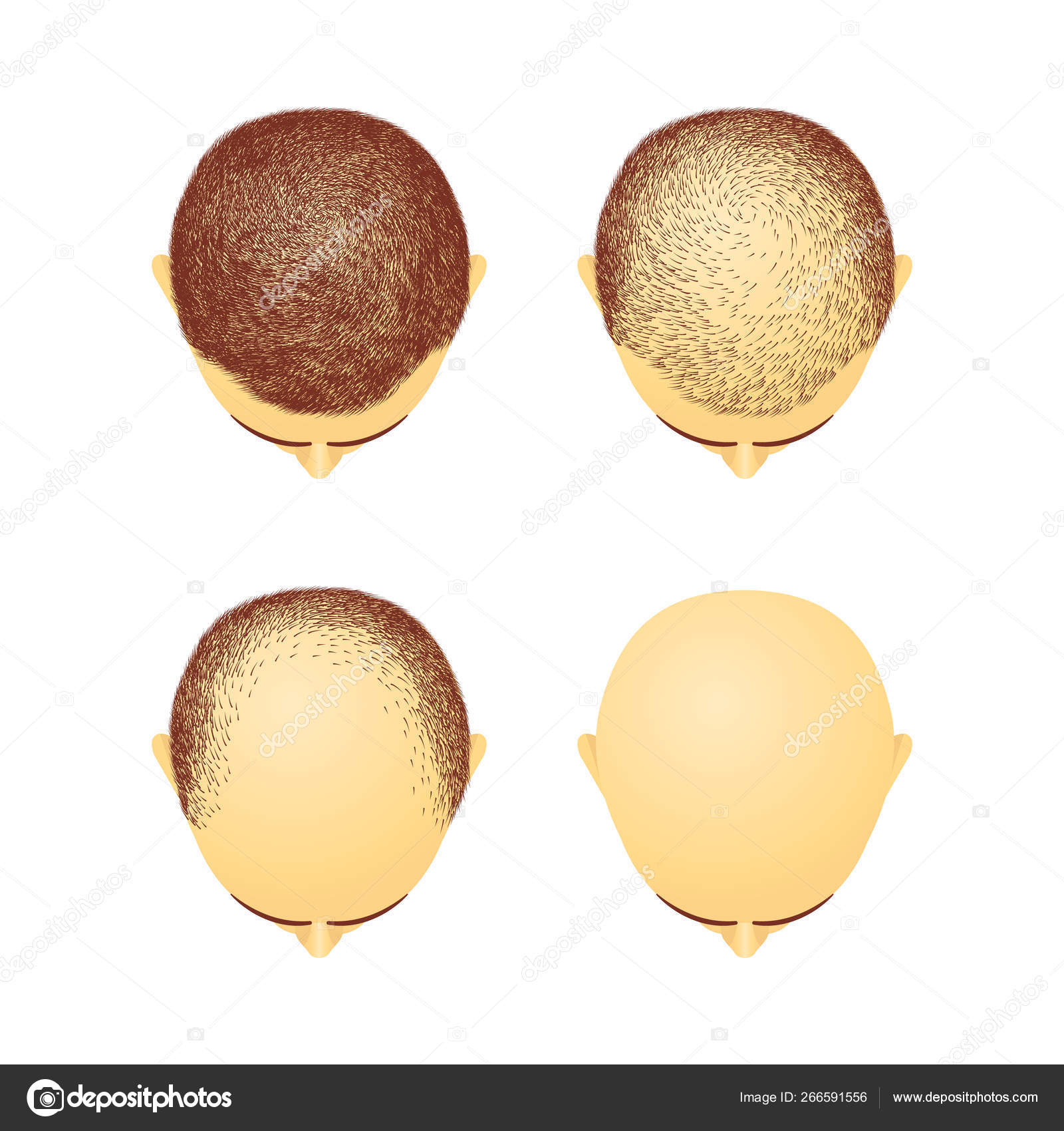 Conjunto de cuatro cabezas masculinas en vista superior con calvicie ...