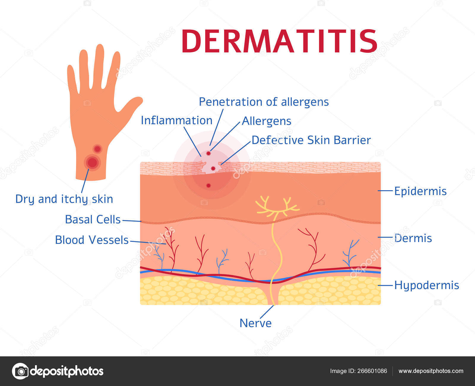 Dermatitis graphic diagram or scheme flat style Stock Vector by ...