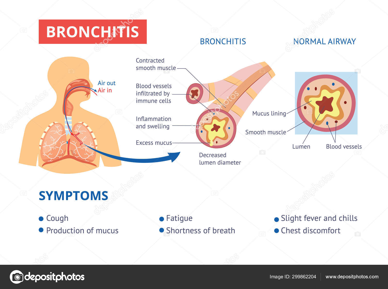 Healthy airway and bronchitis diagnosis symptoms medical banner vector ...