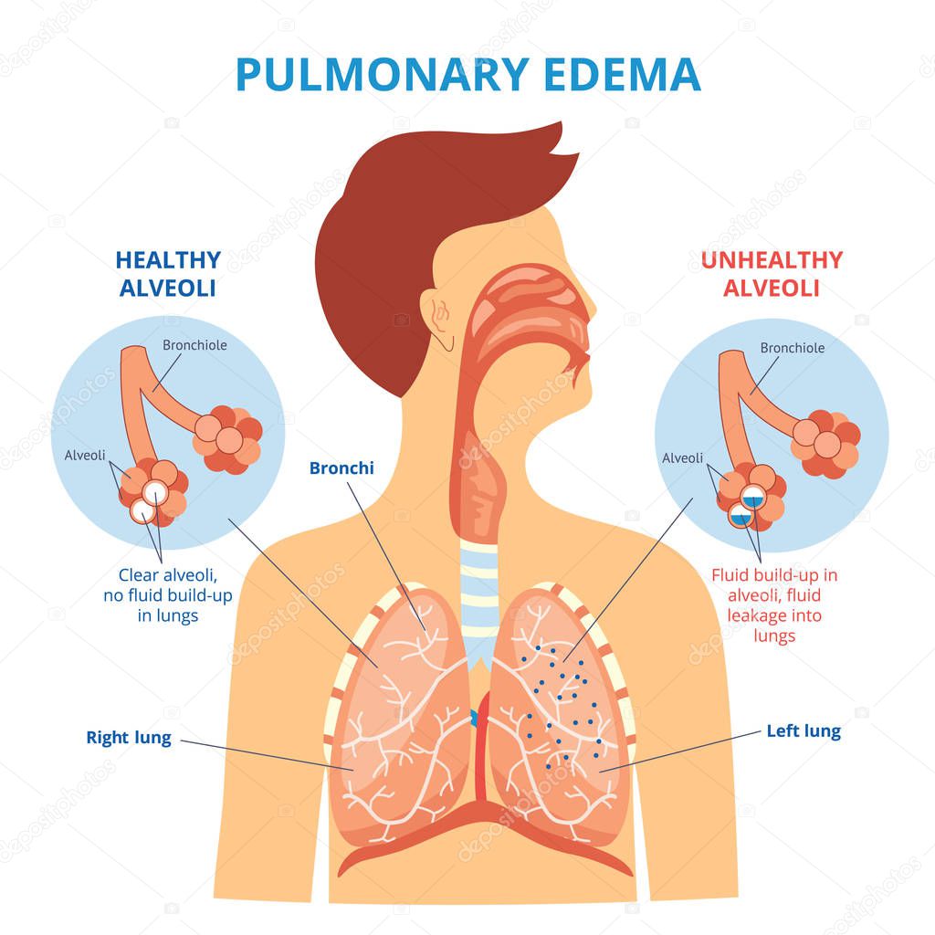 Diagrama De Edema Pulmonar