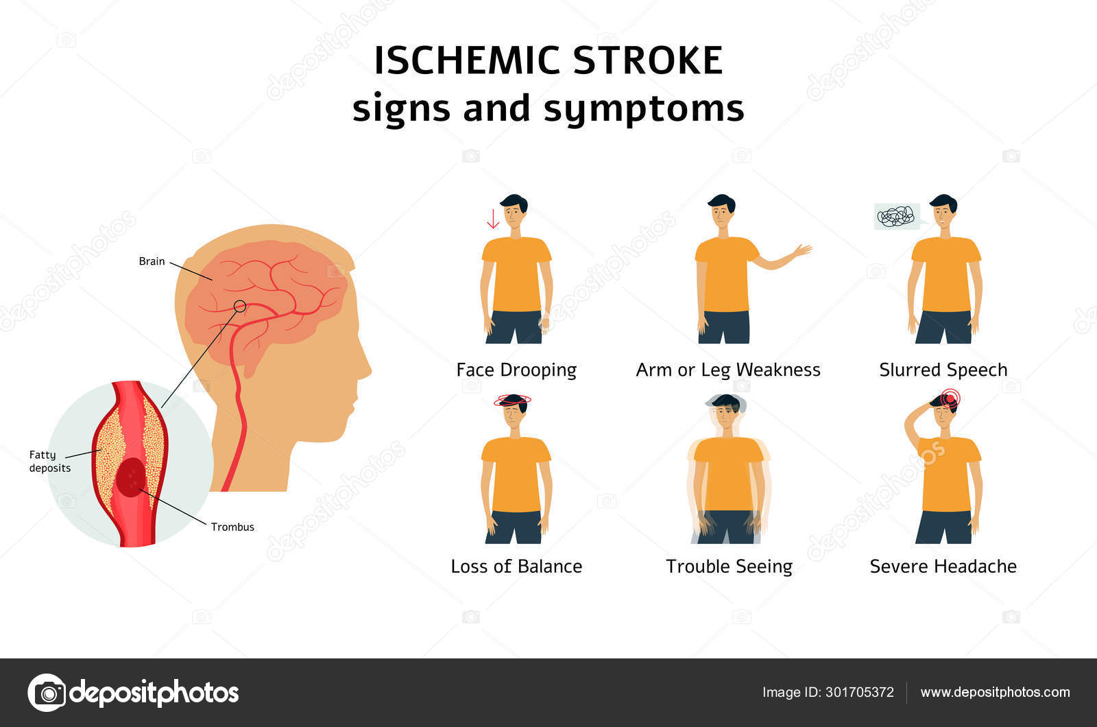 Ischemic Stroke Causes Signs Symptoms Ischemic Stroke Symptoms
