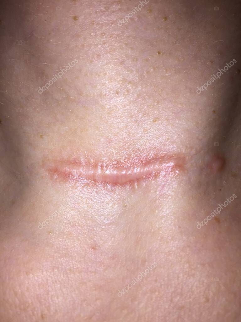 Acercamiento de una cicatriz roja, hipertrófica o queloide elevada en ...