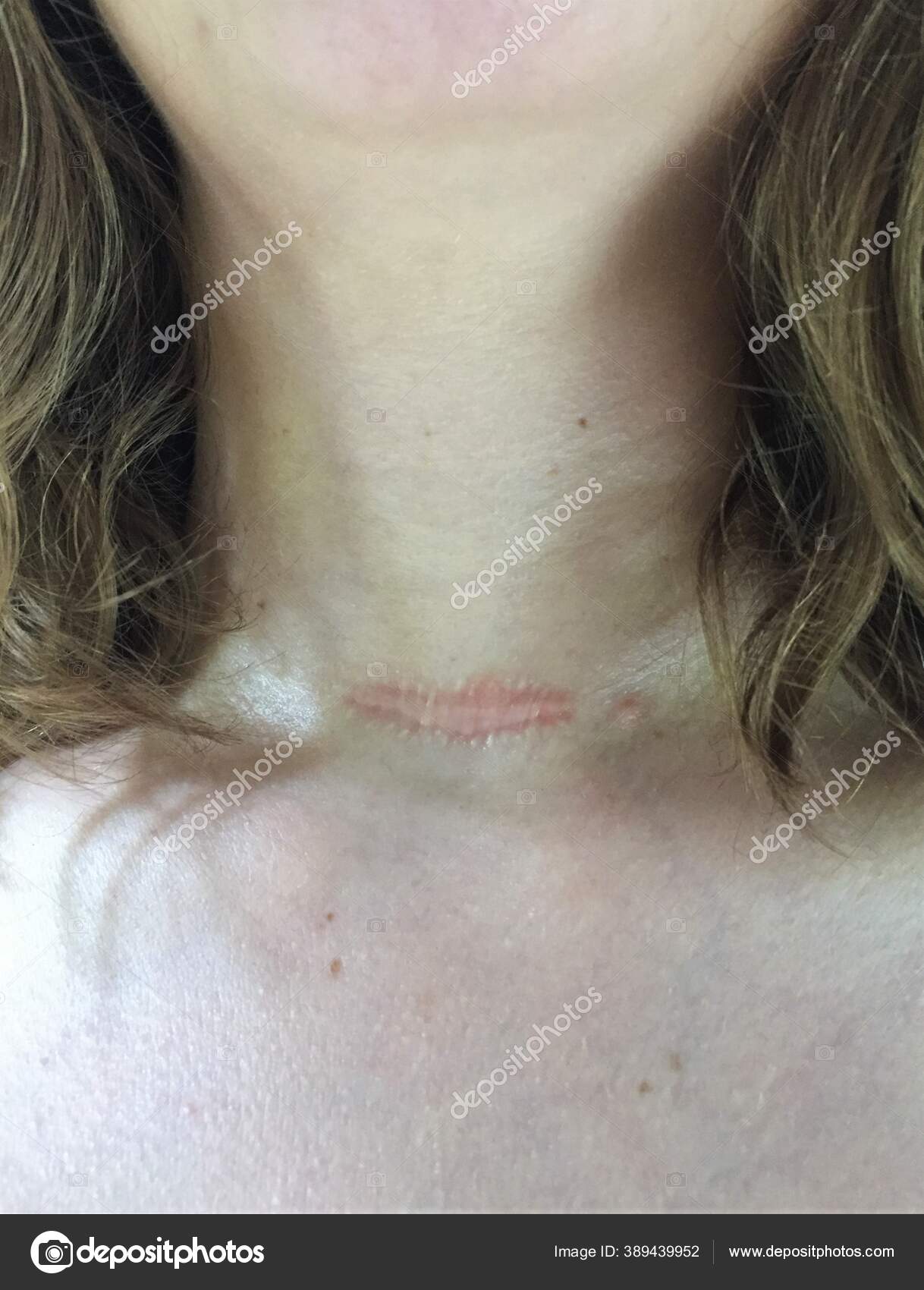 Closeup Red Raised Hypertrophic Keloid Scar Woman Neck One Year — Stock ...