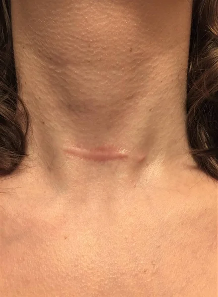 Papillary Thyroid Cancer Scar