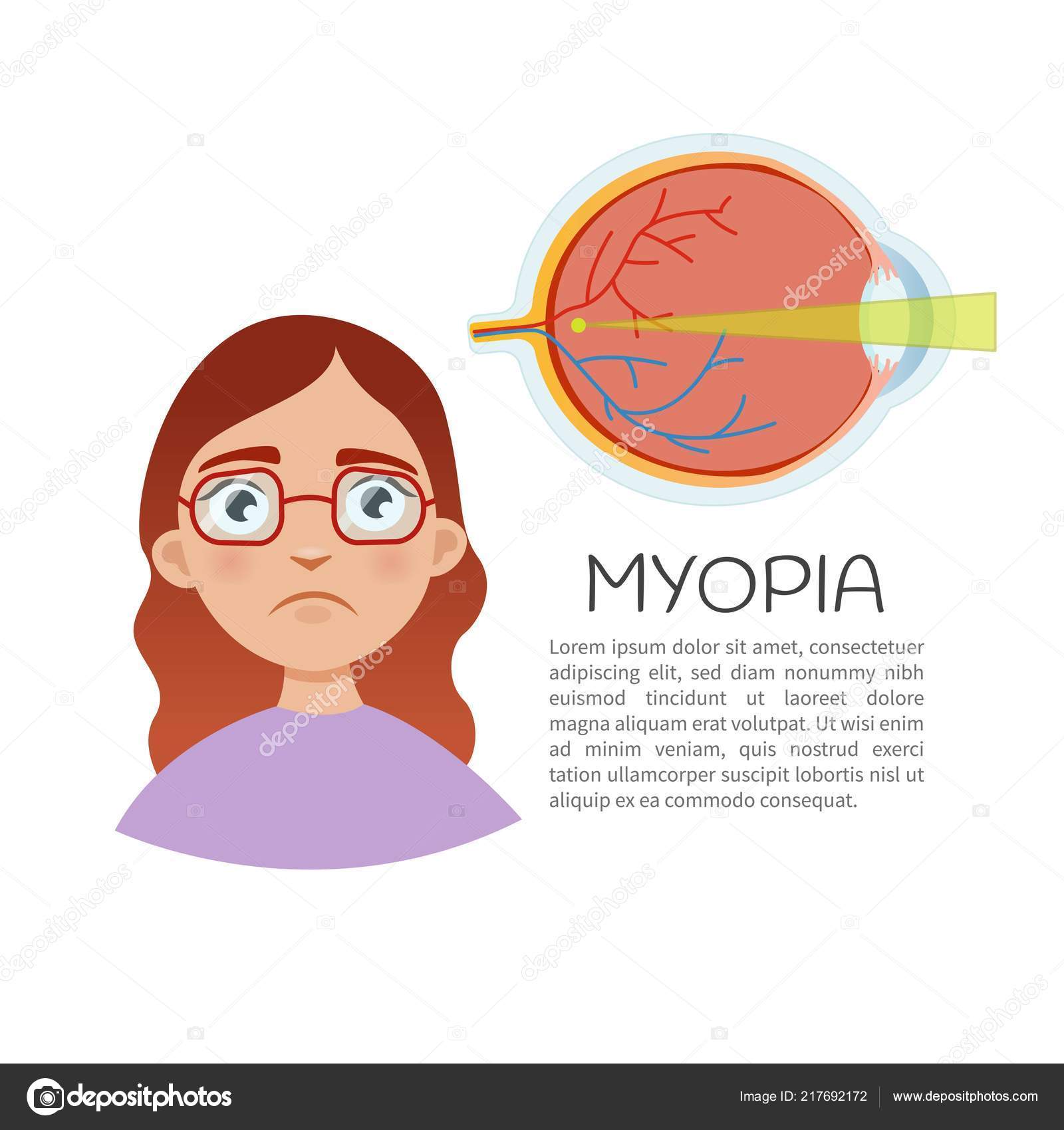 Vector Illustration Defects Vision Myopia Cute Girl Glasses Stock ...