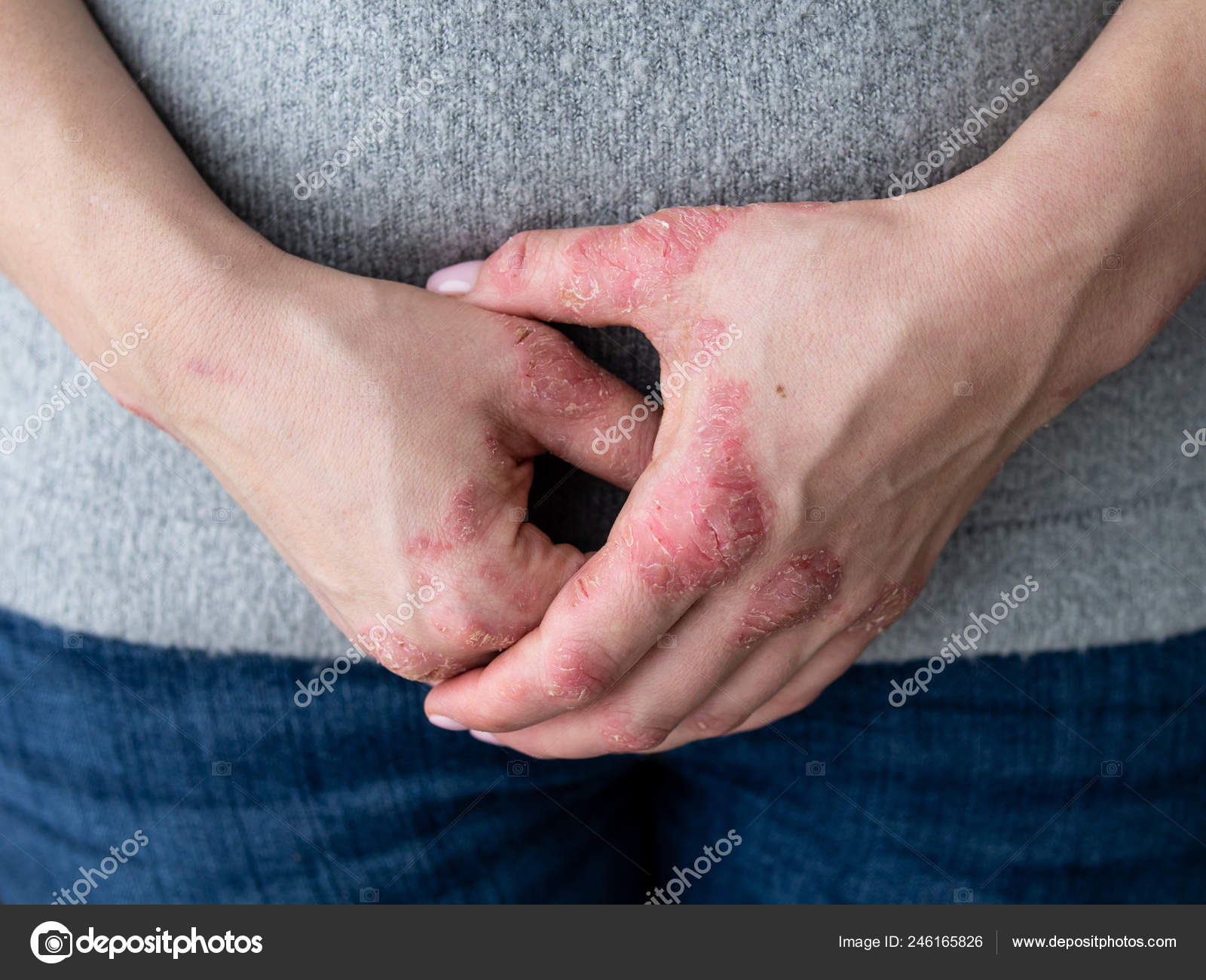 Cracked Flaky Skin Hands Dermatological Problems Psoriasis Hard Horny ...