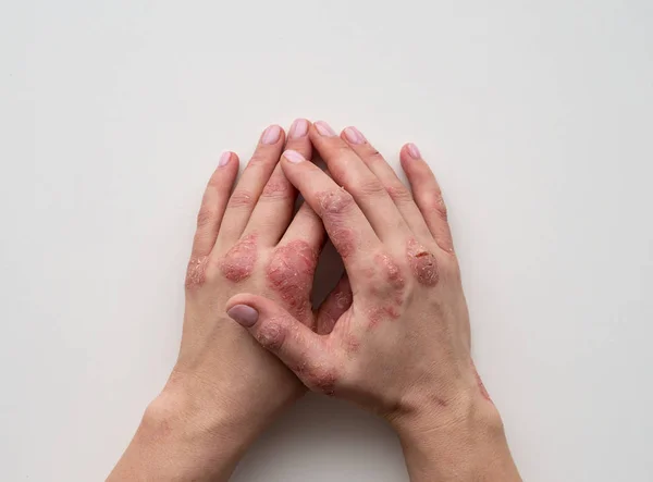Psoriasis sur les mains Stock Photos, Royalty Free Psoriasis sur les ...