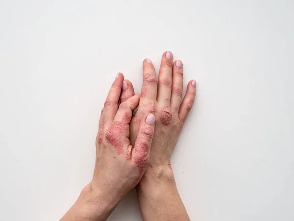 Psoriasis images libres de droit, photos de Psoriasis | Depositphotos