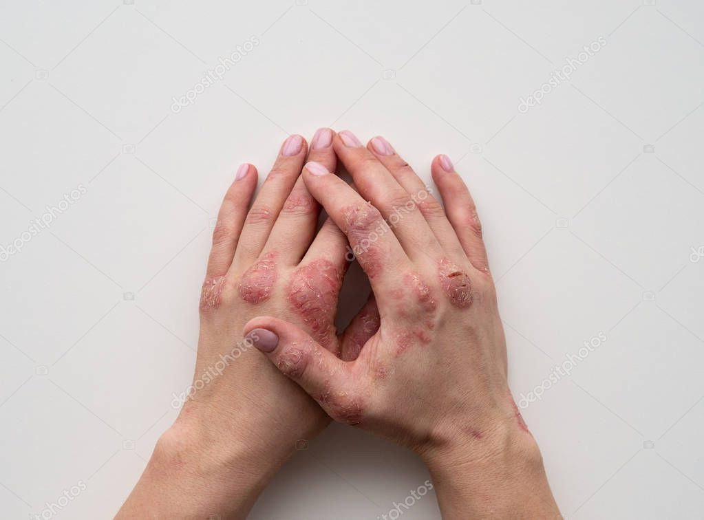 Piel de psoriasis. Primer plano de erupción y descamación en la piel ...