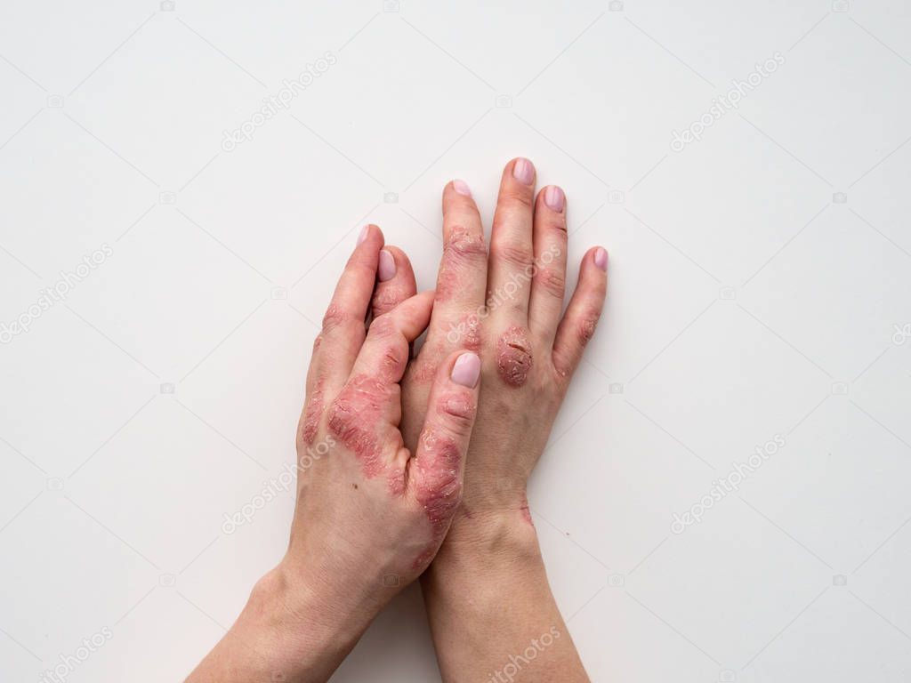 Piel de psoriasis. Primer plano de erupción y descamación en la piel ...