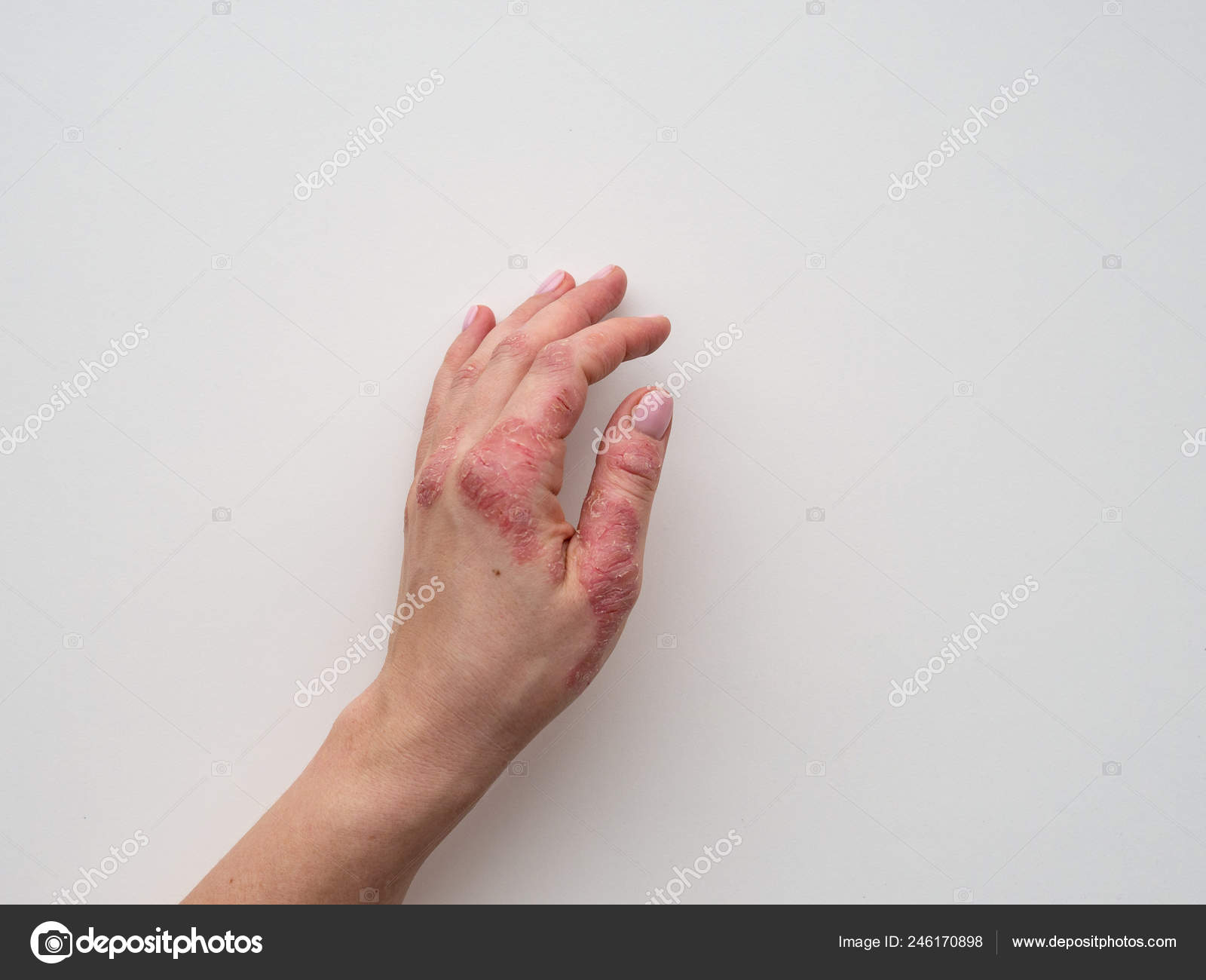 Psoriasis Skin Closeup Rash Scaling Patient's Skin Concept Chronic ...