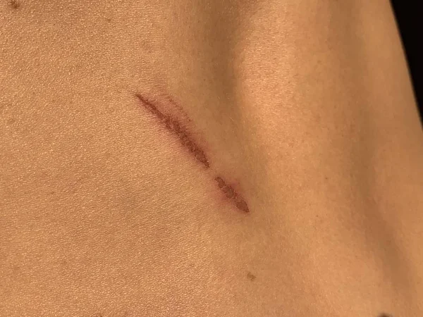 Problemas de cicatriz Stock Photos, Royalty Free Problemas de cicatriz ...