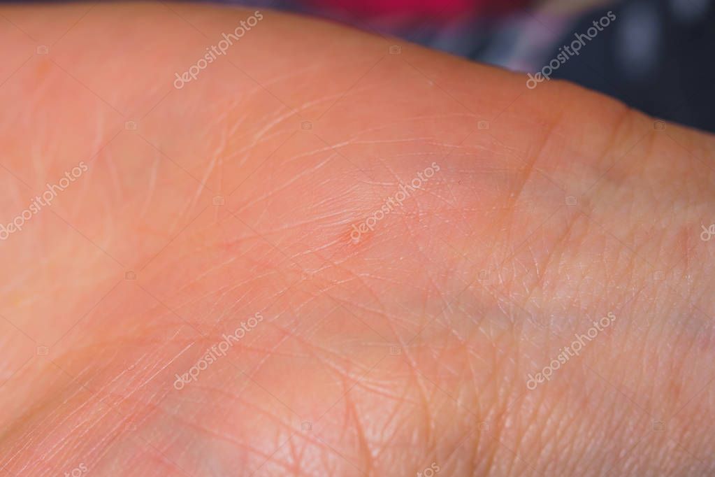 La textura de la piel de las palmas. Virus del papiloma en las manos en ...