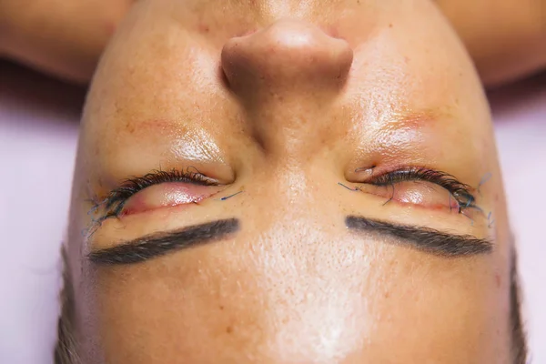 Woman Plastic Surgery Eyes Stitches Eyelids Blepharoplasty Condition ...