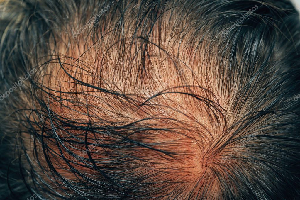 La textura del pelo raro en la cabeza de un hombre. Mesoterapia de ...