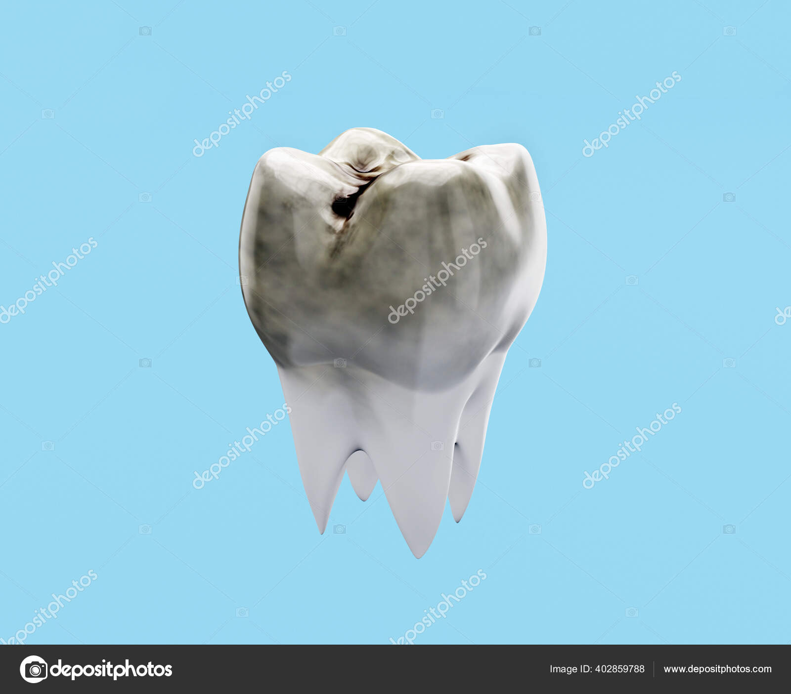 Carious Molar Tooth Blue Background Tooth Decay Concept Caries Render ...