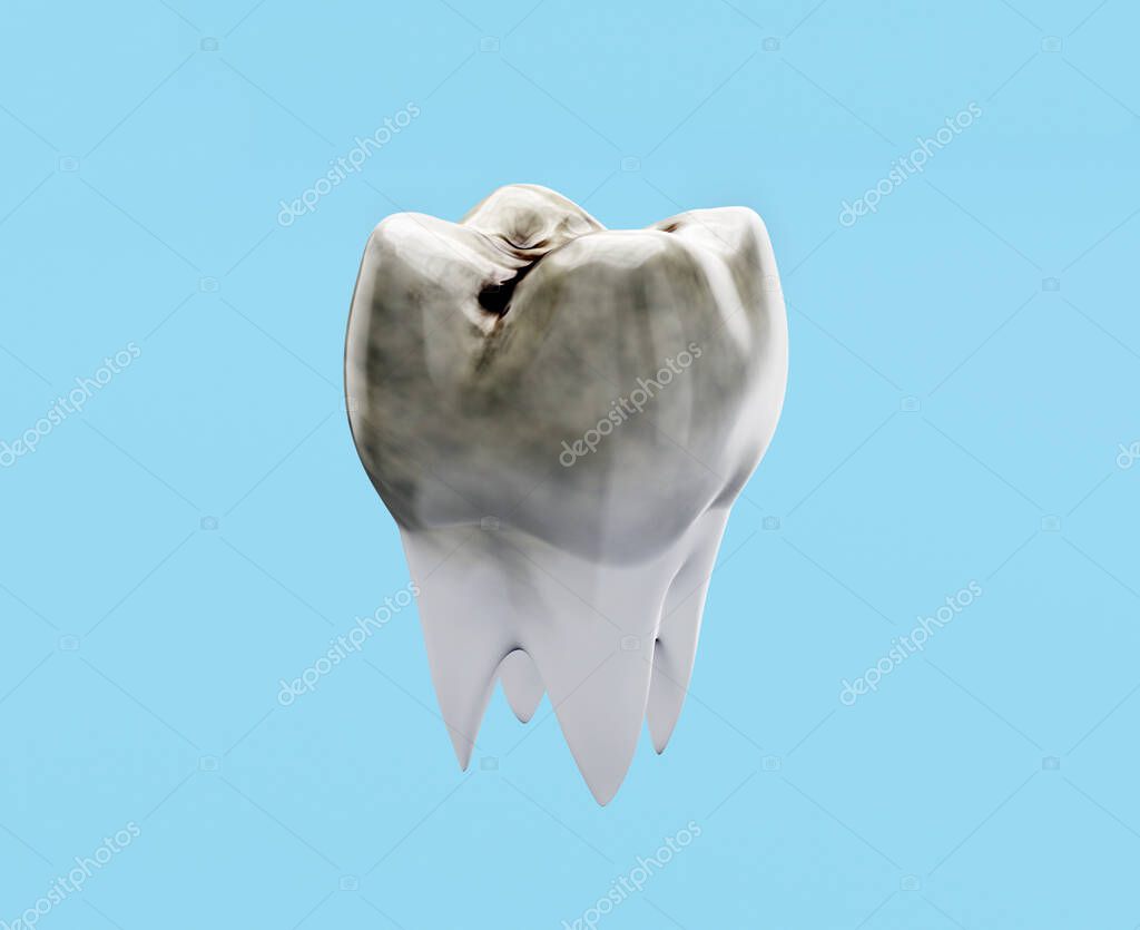 Diente Molar Carioso Sobre Fondo Azul Concepto Caries Caries Render ...