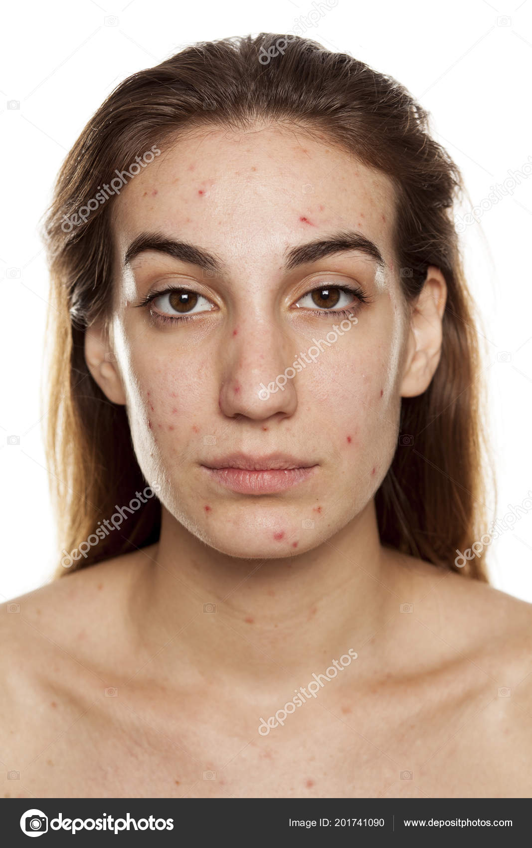 Young Woman Problematic Skin Makeup Posing White Background Stock Photo ...