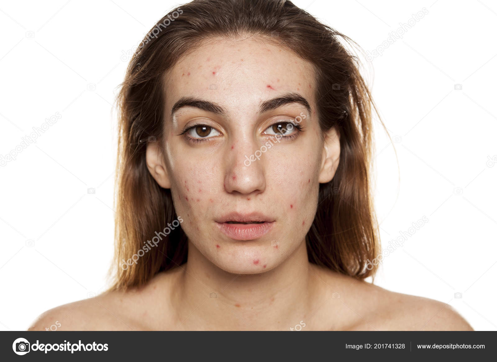 Young Woman Problematic Skin Makeup Posing White Background Stock Photo ...