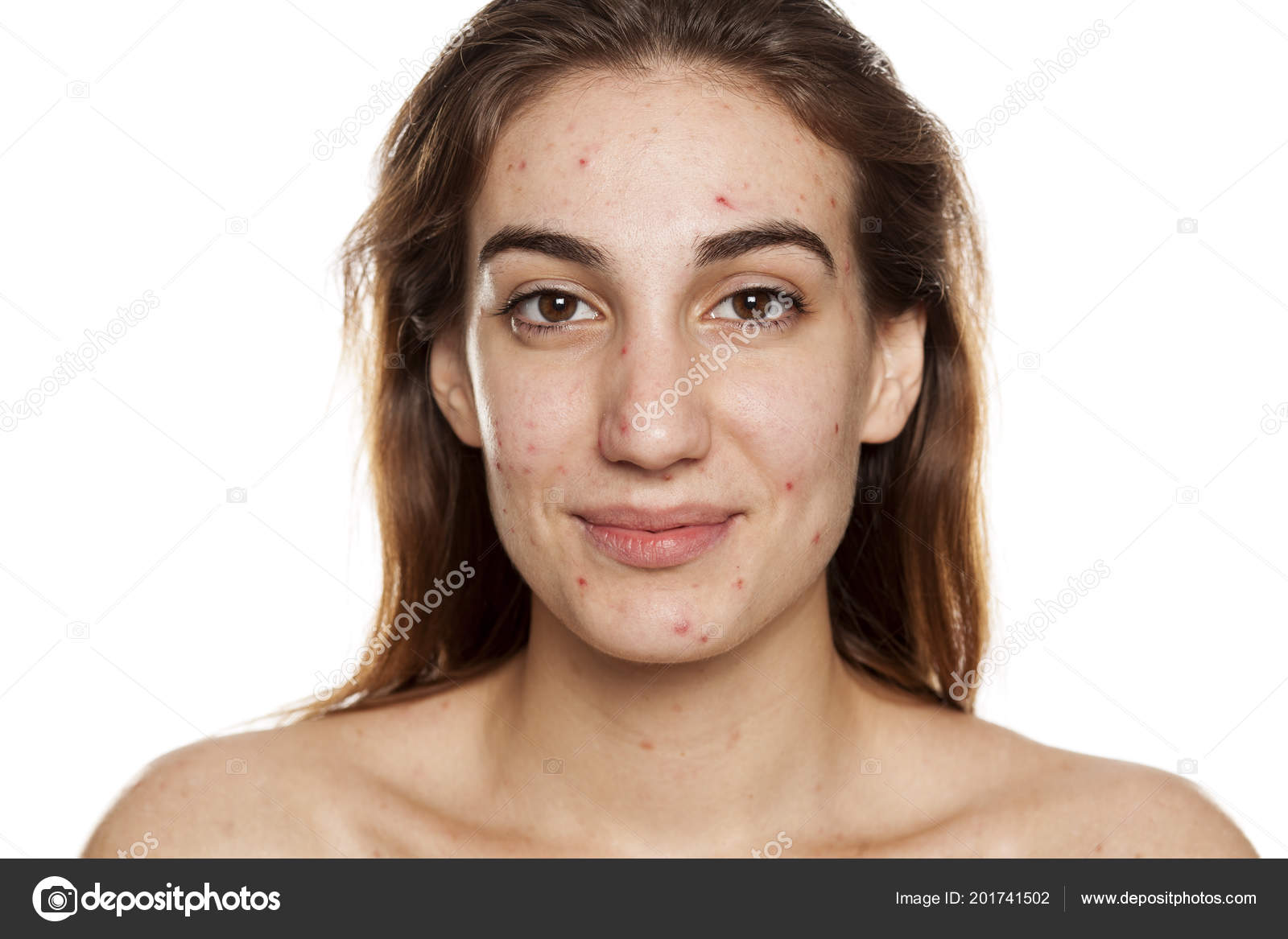 Young Smiling Woman Problematic Skin Makeup Posing White Background ...