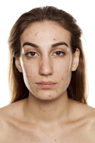 Young Unhappy Woman Problematic Skin Makeup Squeezing Her Acne White ...