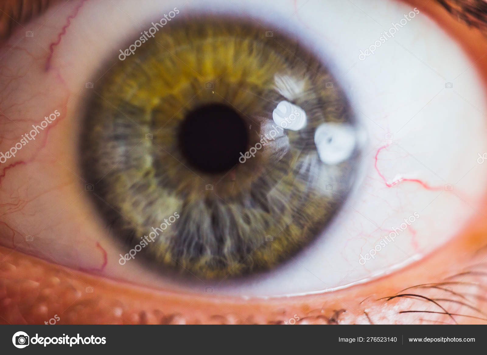 Wide open human eye with bright red arteries close up. irritation and ...