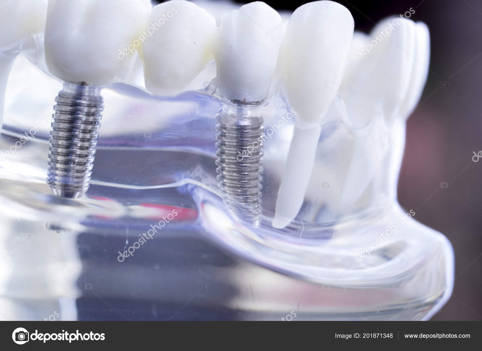 Dentist Dental Teeth Teaching Model Showing Titanium Metal Tooth ...