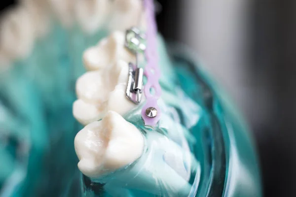 Check Hyrax Braces Dental Gypsum Model Banded Hyrax Expander Rapid ...