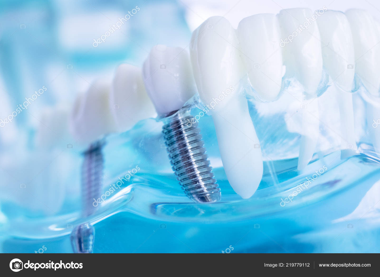 Dentist Dental Teeth Teaching Model Showing Titanium Metal Tooth ...