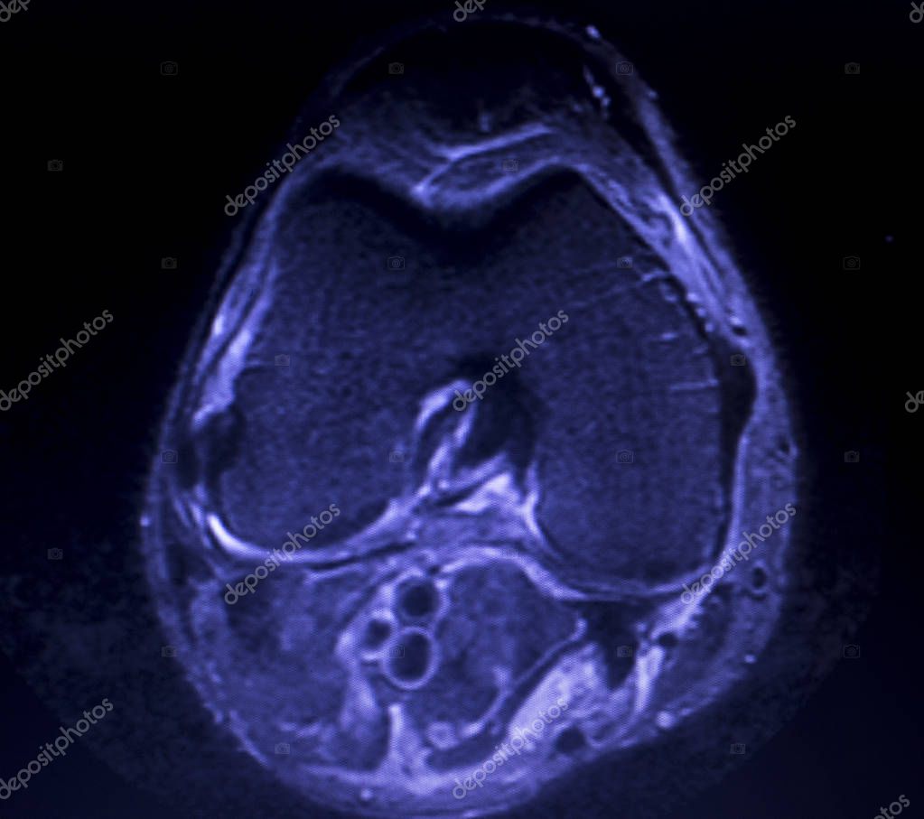 Resonancia Magnética Por Resonancia Magnética Rmn Rodilla Cuerno ...