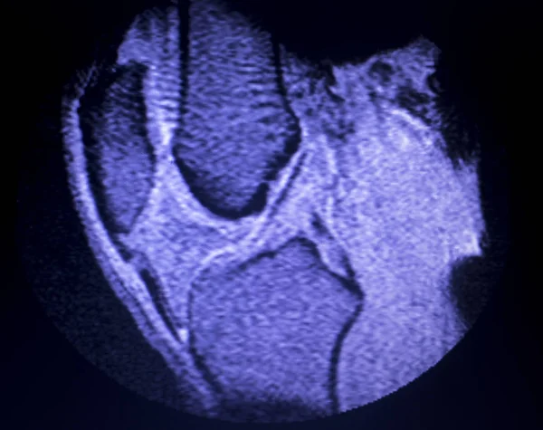 Tear of the lateral meniscus Stock Photos, Royalty Free Tear of the ...