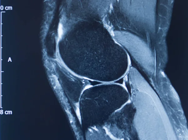 MRI scan hasil tes cedera meniskus lutut — Foto Stok © edwardolive ...