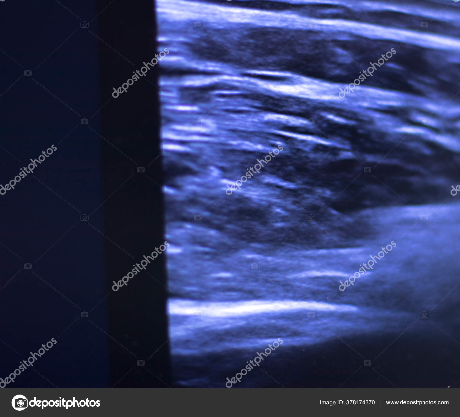 Epi Intratissue Percutaneous Electrolysis Dry Needling Ultrasound ...