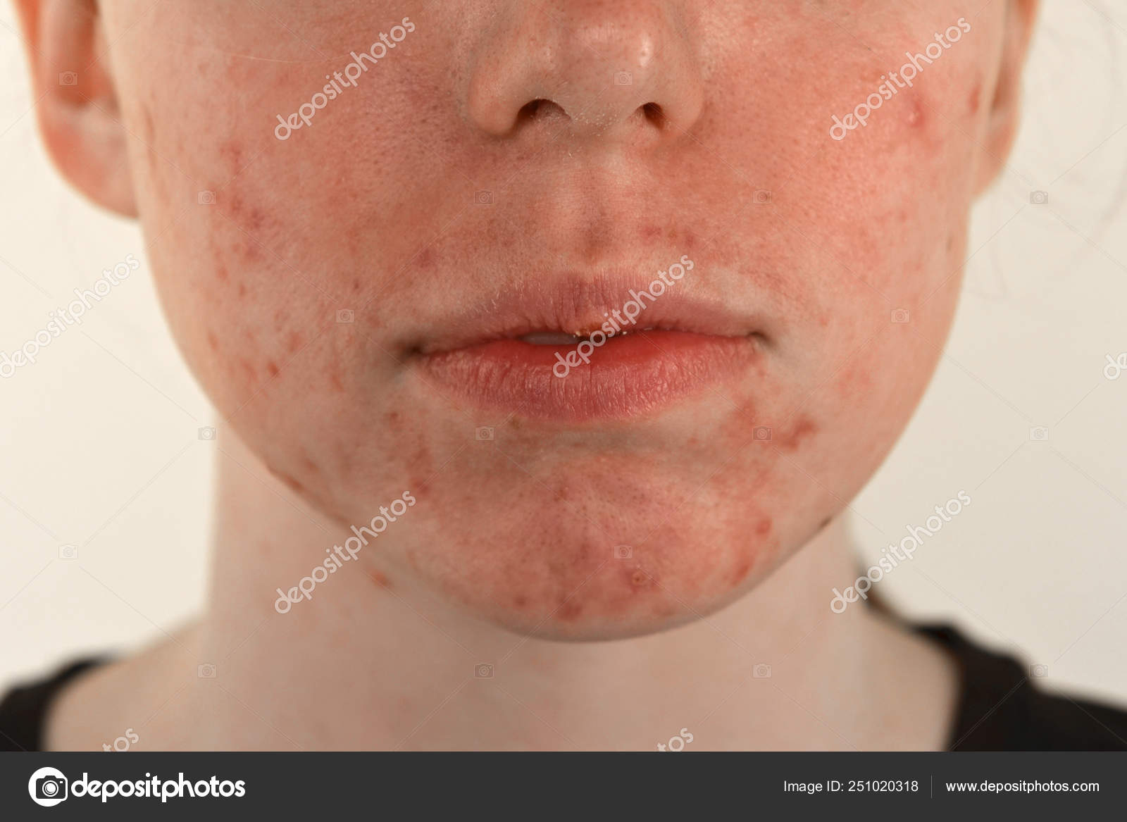 Post-acne, scars and red festering pimples on the face of a young woman ...