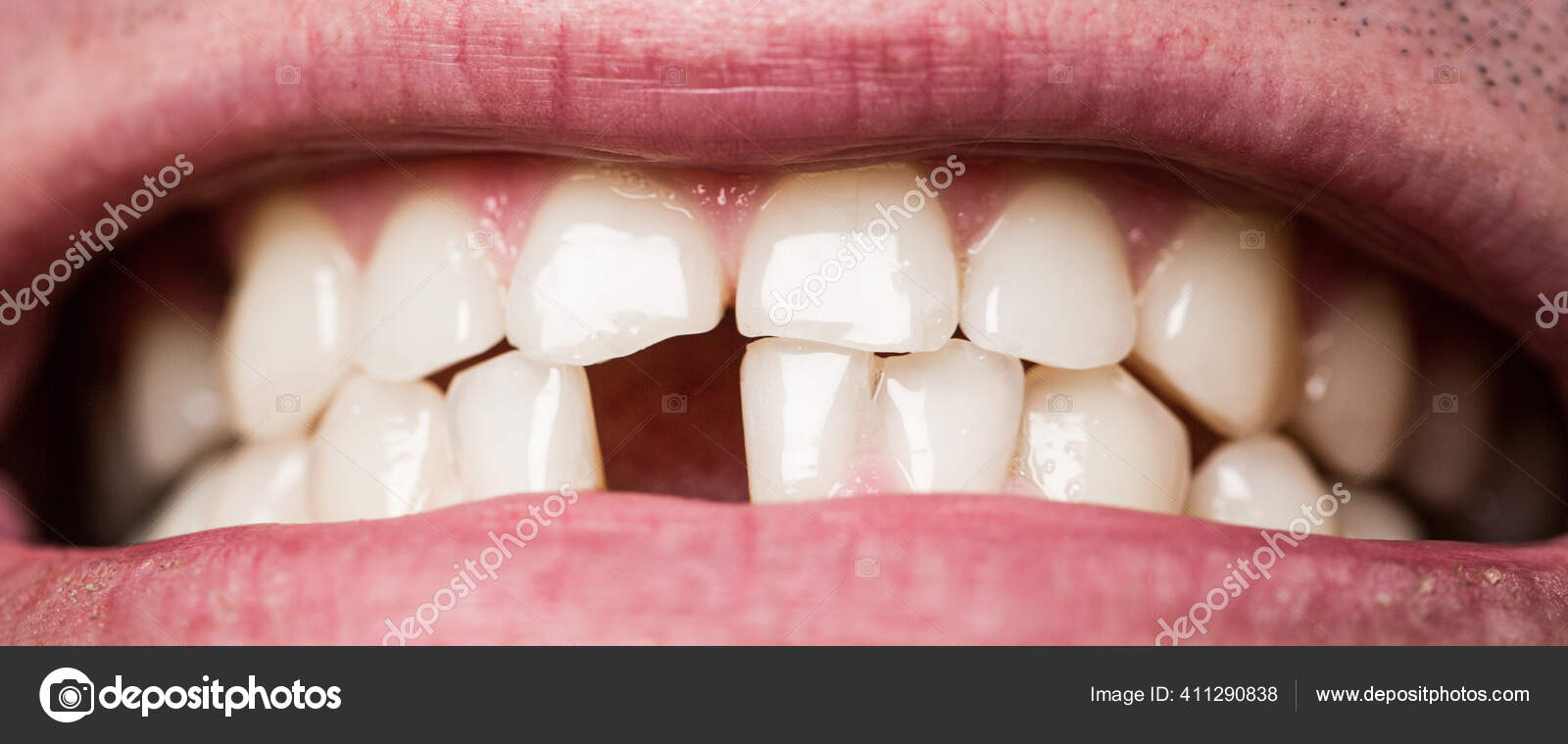 Smil Mann Tenner Fjord Dental Et Smil For Fremtiden