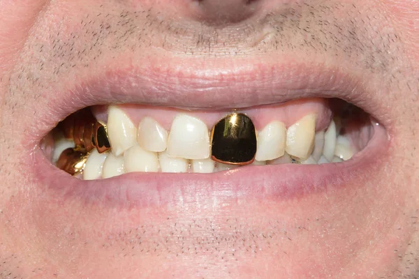 Gold Front Tooth Crown