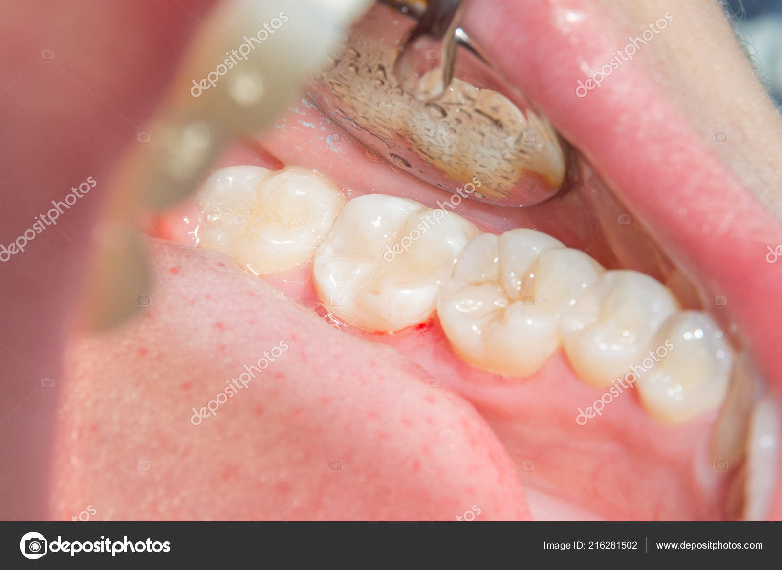 Primer Plano Diente Carioso Podrido Humano Etapa Tratamiento Una ...