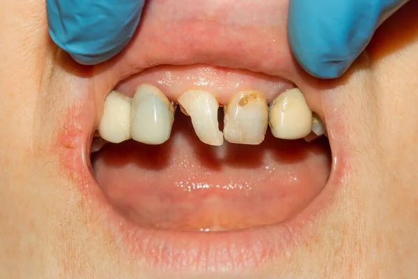 Rotten teeth Images - Search Images on Everypixel