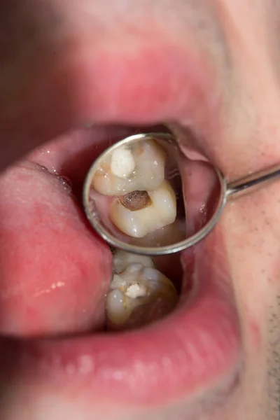 Rotten teeth Images - Search Images on Everypixel