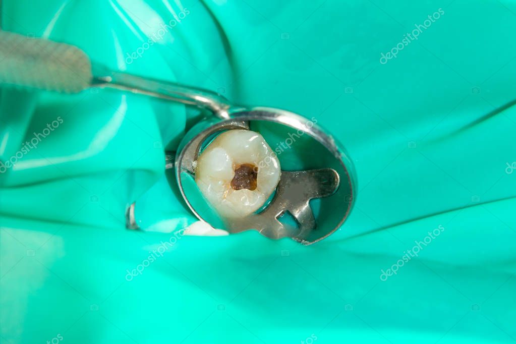 primer plano de un diente carioso podrido humano en la etapa de ...