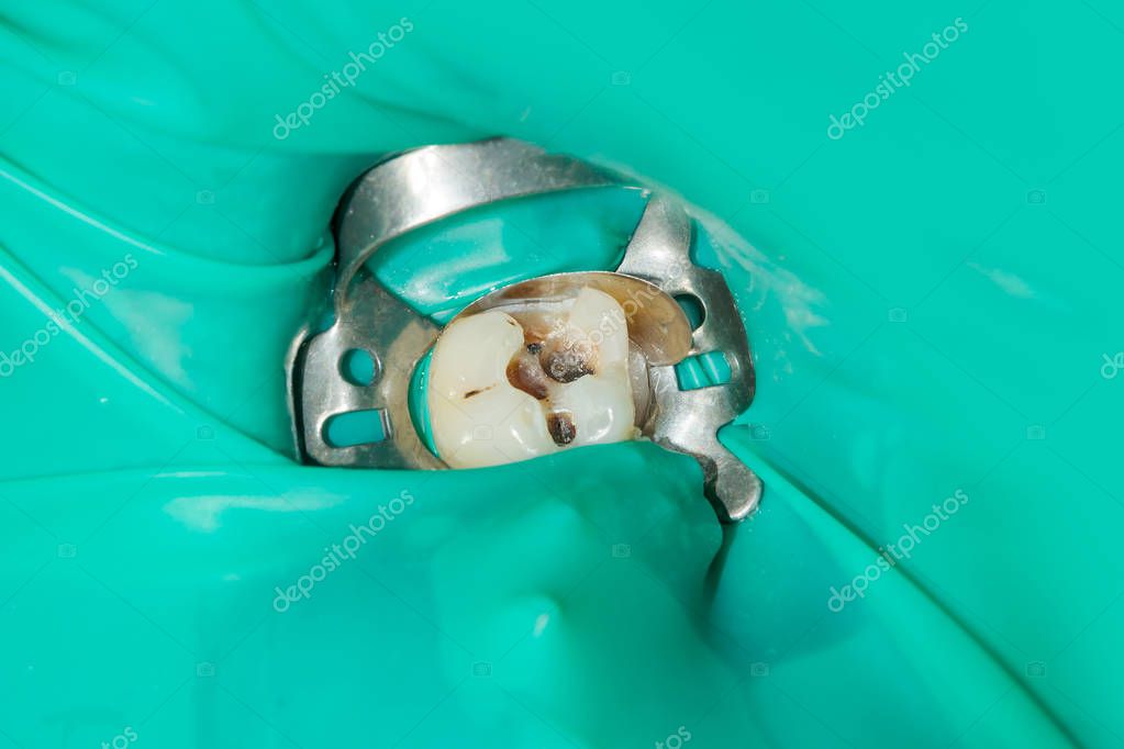 primer plano de un diente carioso podrido humano en la etapa de ...