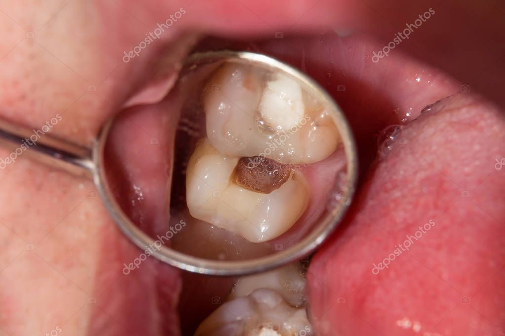 primer plano de un diente carioso podrido humano en la etapa de ...