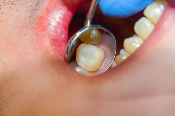 Rotten teeth Images - Search Images on Everypixel