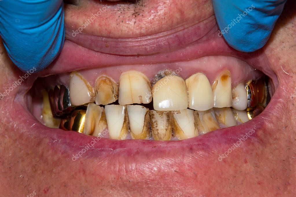 primer plano de un diente carioso podrido humano en la etapa de ...