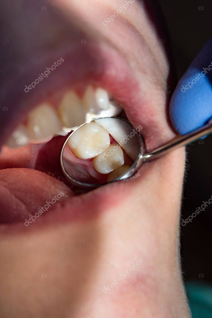 primer plano de un diente carioso podrido humano en la etapa de ...