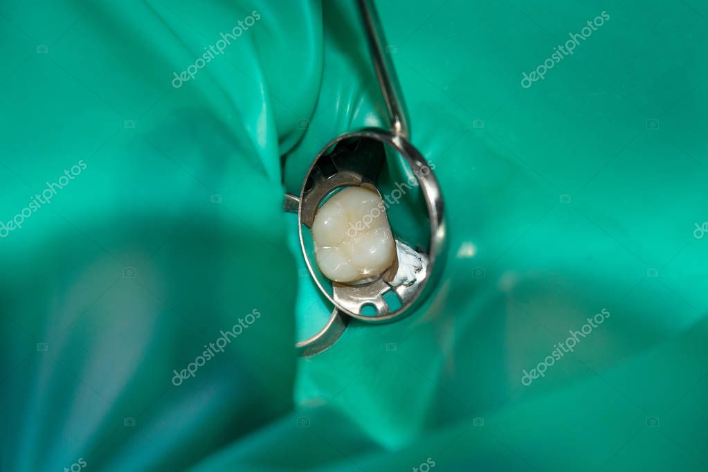 primer plano de un diente carioso podrido humano en la etapa de ...